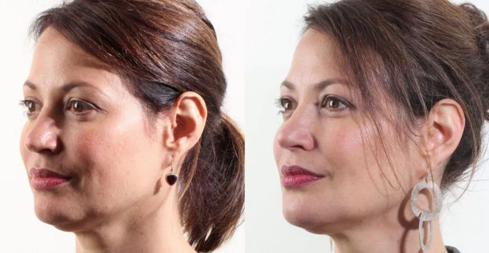 Princess Instalifting – Marissa Aesthetic & Wellness